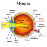 Difference Between Myopia, Hypermetropia And Presbyopia (With Diagram ...