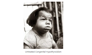 Difference Between Dwarfism and Cretinism - VIVA DIFFERENCES